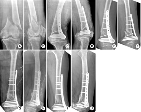 Surgical Treatment Of Distal Femoral Fractures Using A Distal Femoral