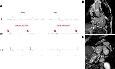 cavotricuspid isthmus ablation guided by real time magnetic resonance