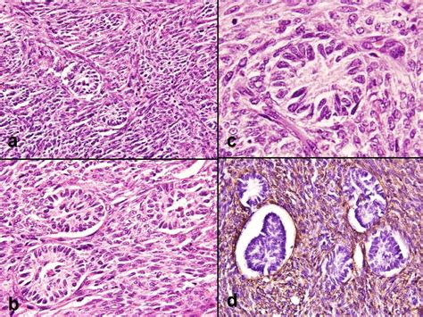 fibroma with minor sex cord elements an incidental finding in a