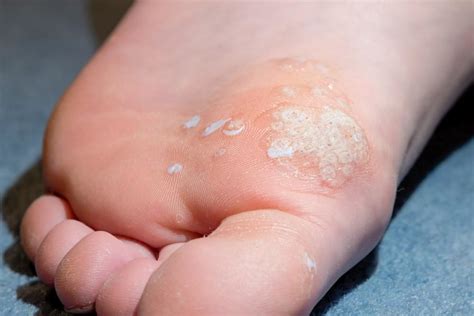 What Causes Plantar Warts Manhattan Podiatry Associates Pc Podiatrists