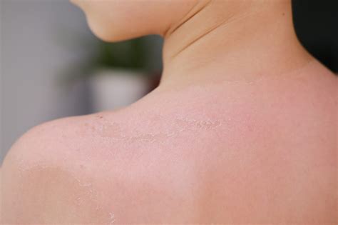 〔子どもの日焼け対策〕赤みやヒリヒリを長引かせない！アフターケアの方法とは？ 敏感肌コンシェルジュ│dr ウィラード・ウォーター