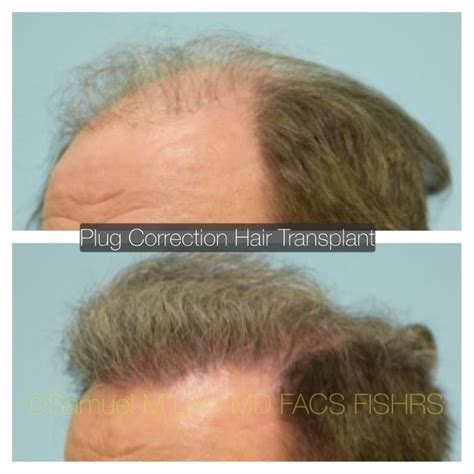 Hair Transplant Before And After Gallery Artofit