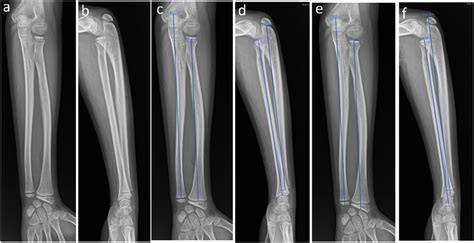 Anterior Posterior Ap And Lateral Lat Radiographs Of The Left