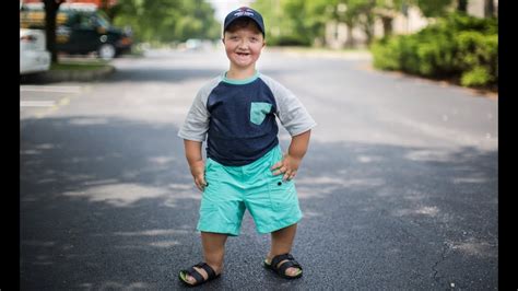 Dwarfism Height