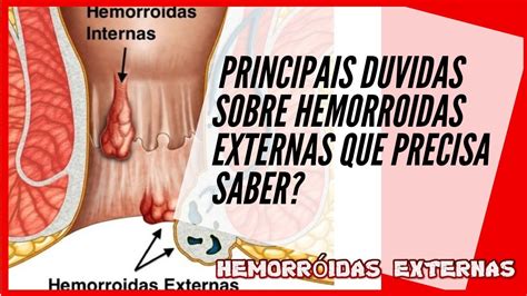 Hemorroidas Externas💜principais Duvidas Frequentes Sobre Hemorroidas