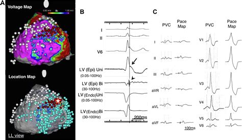 Radiofrequency Catheter Ablation Of The Left Ventricular Epicardium As