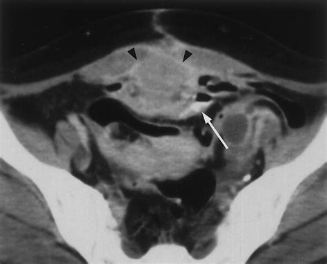Urachal Remnant Diseases Spectrum Of Ct And Us Findings Radiographics