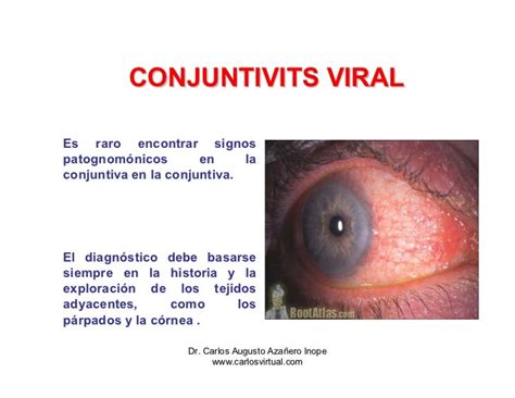 Conjuntivitis Viral