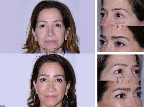 Hair Restoration Nyc Center Hair Transplantation Clinic New York City