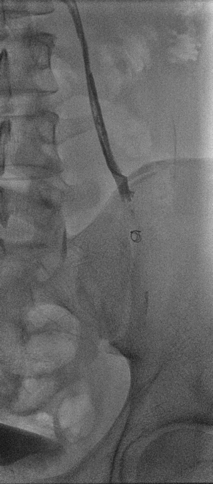 Varicocele Embolization With Polidokanol And Coil Image
