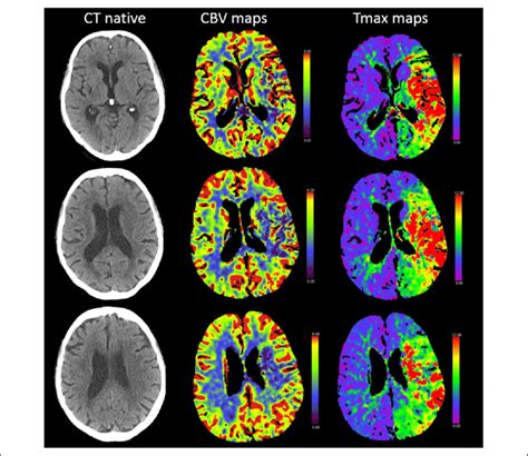 Perfusion Map