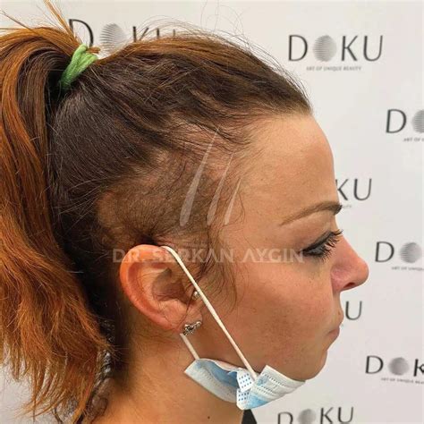 Haartransplantation Türkei Vorher Nachher Ergebnisse Dr Serkan Aygin