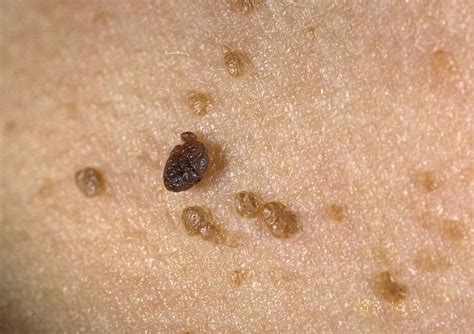 Seborrheic Keratosis Symptoms Causes Diagnosis And Treatment