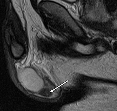 Spectrum Of Extratesticular And Testicular Pathologic Conditions At