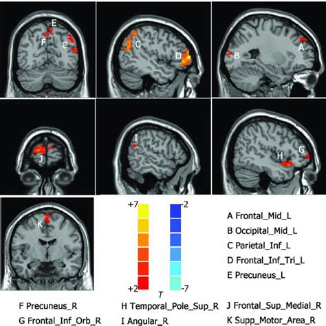 A Brain Functional Connectivity Fc Of Rs Fmri In Mdd Without Cm