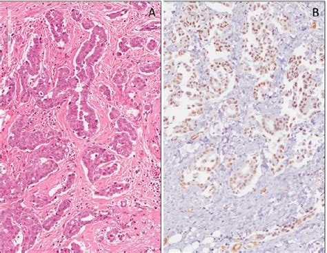 Figure 3 From Immunohistochemical Expression Of Wilms Tumor 1 Protein