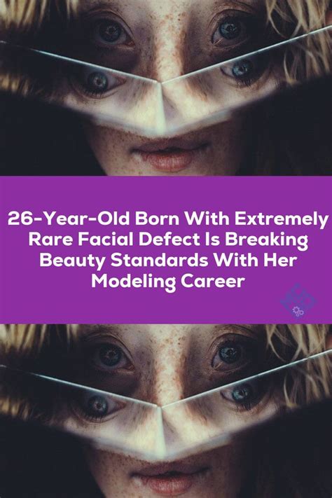 26 Year Old Born With Extremely Rare Facial Defect Is Breaking Beauty