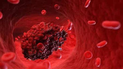 Embolia Cerebral Síntomas Tipos Y Causas Mejor Con Salud