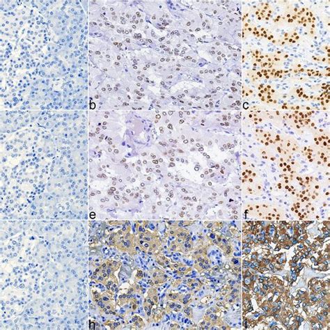 Phox2b Is A Sensitive And Specific Marker For The Histopathological