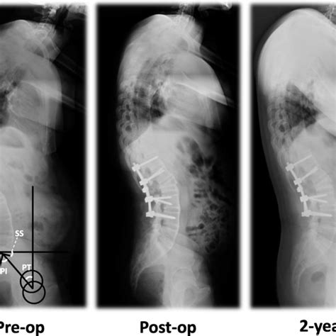 Preoperative Immediate Postoperative And 2 Year Postoperative Standing