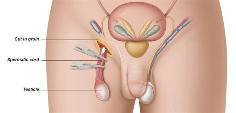 46 Xy Differences Of Sexual Development Endotext Ncbi 43 Off