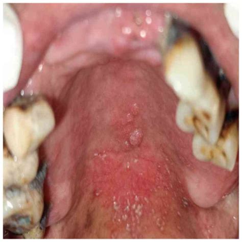 Human Papillomavirus And Oral Manifestations In A Patient With Hiv A
