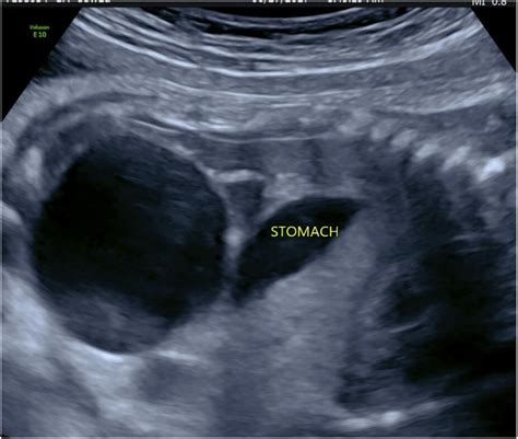 Ovarian Cysts American Journal Of Obstetrics And Gynecology