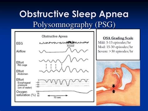 Sleep Apnea And The Eye 2015