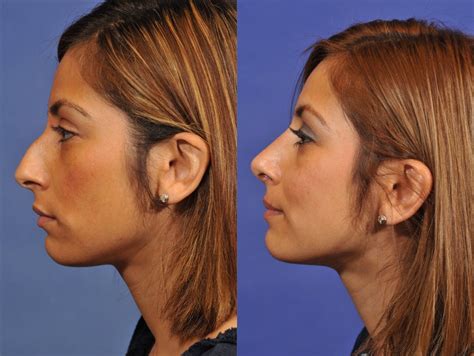 Rhinoplasty Before And After 6 Jesse E Smith Md Facs Ft Worth