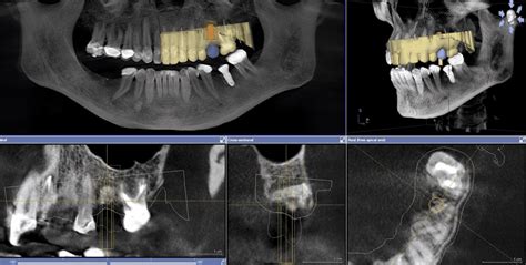 Why Cbct Cone Beam Ct Scan Is A Must For Patients 55 Off
