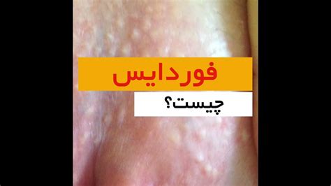 دانه‌های فوردایس چیستند؟ دکتر سید امین میرصادقی Youtube