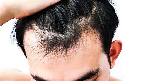 Does Prp Really Work For Hair Loss Dr Gary Linkov Youtube