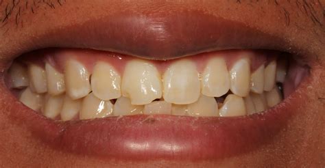 Dental Bonding In Nyc Before And After Photos