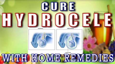 Home Remedies For Hydrocele Ii जलवृषण का घरेलू उपचार Ii Youtube