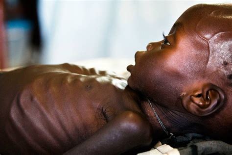 Pelo Menos 1 5 Milhões De Crianças Subnutridas Em África Não Recebem