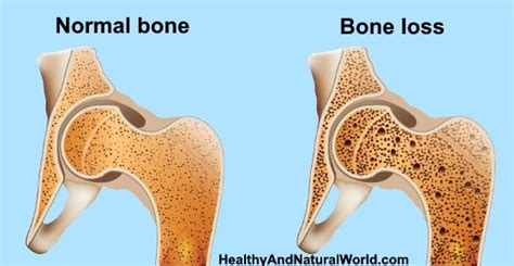 How To Increase Bone Density And Bone Health Osteoporosis Diet