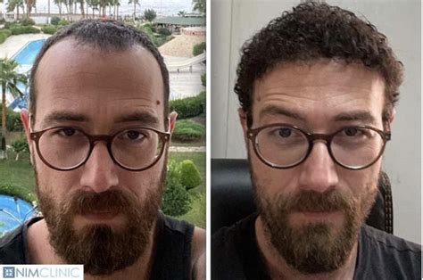 Top 10 Best Hair Transplants In Turkey And Costs In 2023 The Times Of