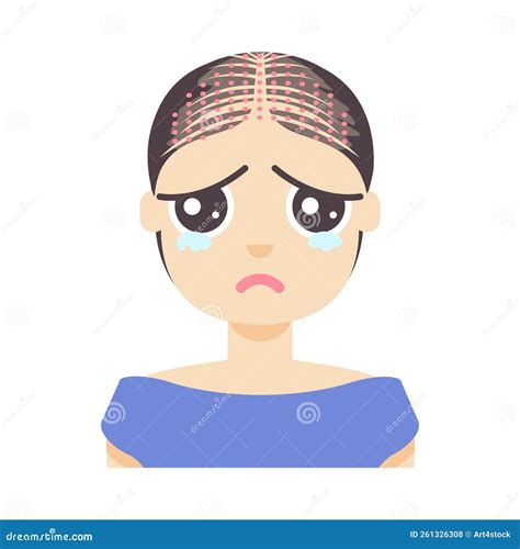 Fue Hair Transplant Treatment Of Alopecia Illustration Stock Vector