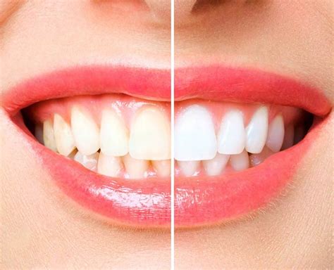 Have Yellow Teeth Then These Home Remedies Will Take Care Of Them