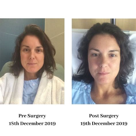 Breast Implant Illness Explant Story Kate Alderman Somatic Sexologist