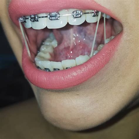 Braces Elastics Types