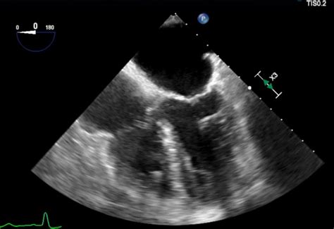 Echocardiography Tutorial Echocardiographic Modes
