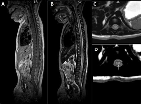 B Spinal Cord Mri Sagittal T1 Weighted A And T2 Weighted Images B