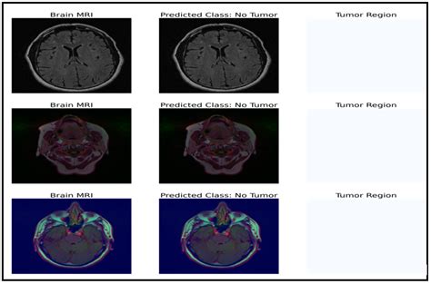 Life Free Full Text Brain Tumor Detection And Classification Using