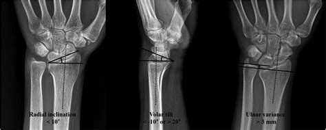 Frontiers Forearm Bone Mineral Density As A Predictor Of Reduction
