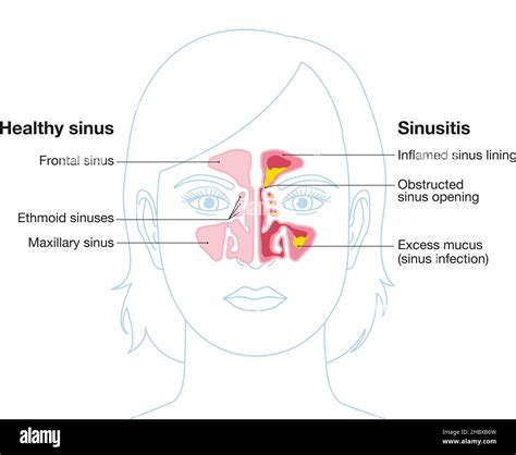 Ilustración Vectorial Que Muestra Un Seno Sano Y Sinusitis Con