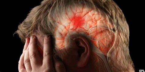 Síntomas Del Derrame Cerebral 】