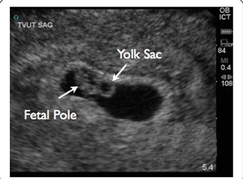 Trans Vaginal Ultrasound Image Showing Yolk Sac And Fetal Pole
