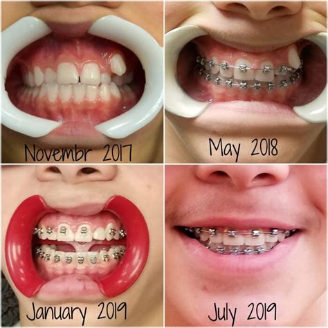 How To Take Off Braces Braces Colors Wheel Nodegasm