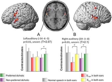 Whole Brain Fmri Results The Preferred Dichotic Condition Yielded More